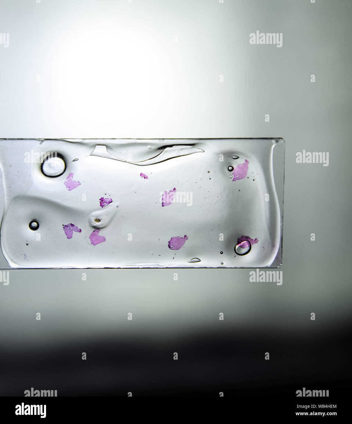 Slices of the tumor under glass. Histological examination of tumor ...