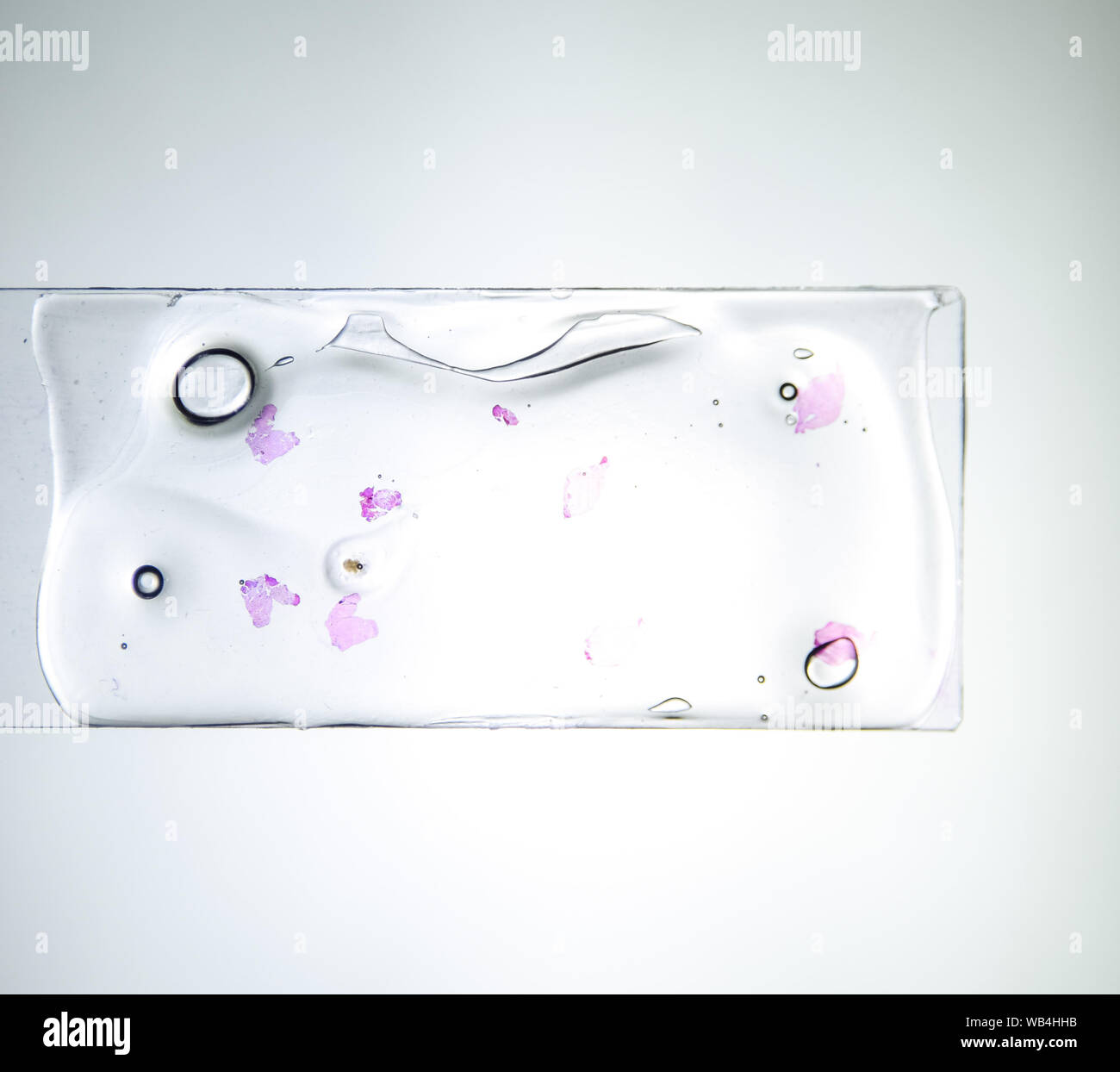 Slices of the tumor under glass. Histological examination of tumor ...