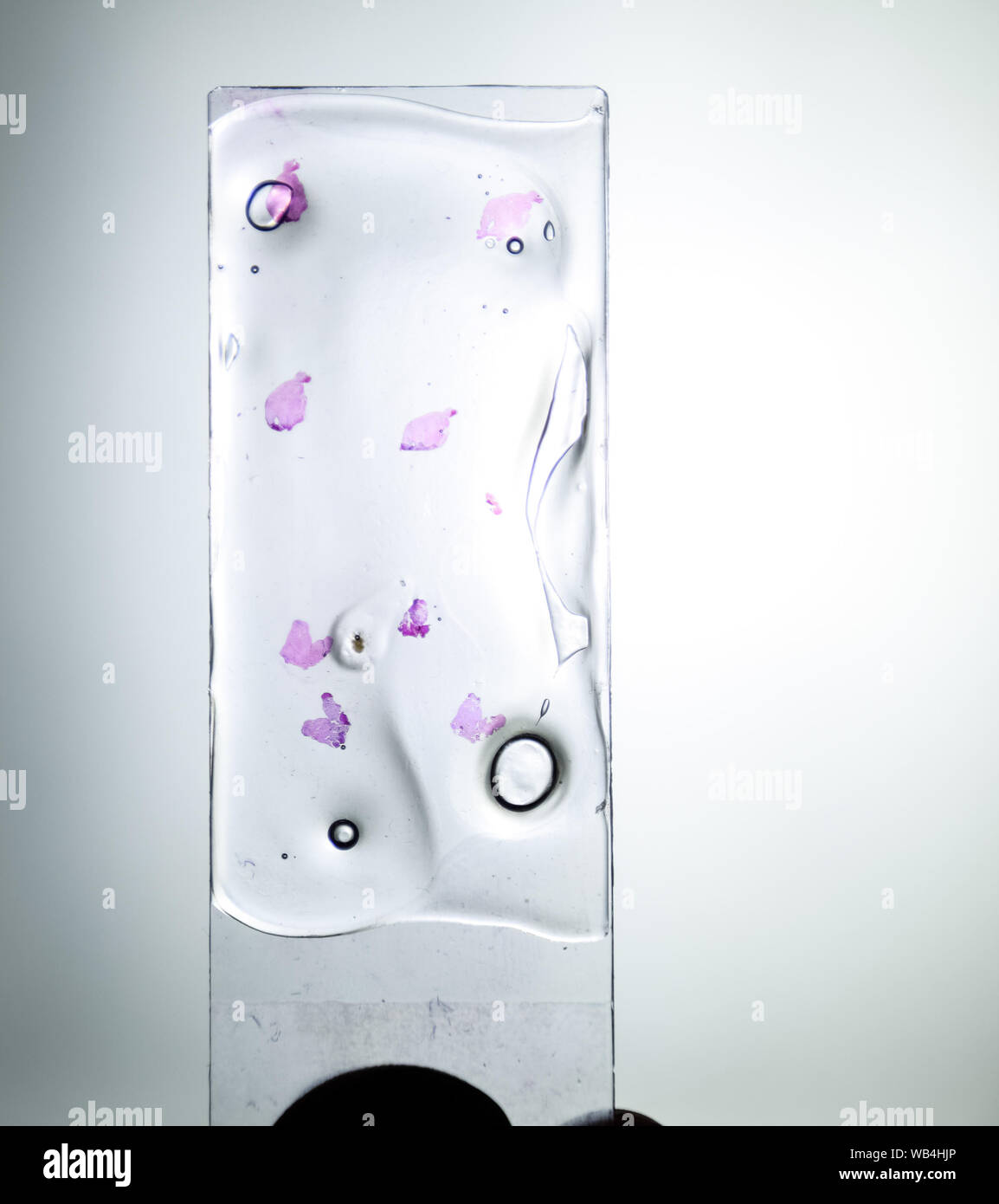 Malignant melanoma micrograph hi-res stock photography and images - Alamy