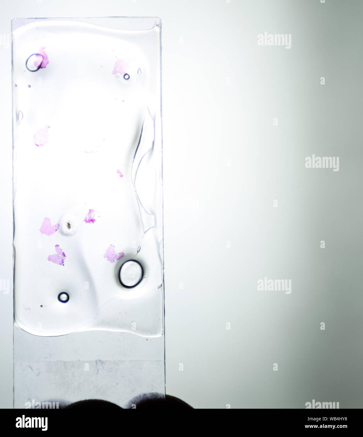 Slices of the tumor under glass. Histological examination of tumor ...