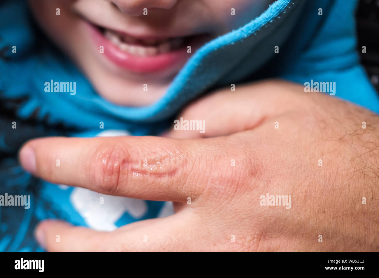 Trace of teeth bite on skin. Bad behavior of child concept Stock Photo ...