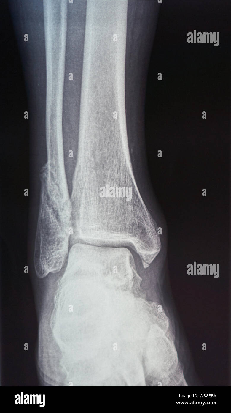 Bone scan of a foot Stock Photo - Alamy