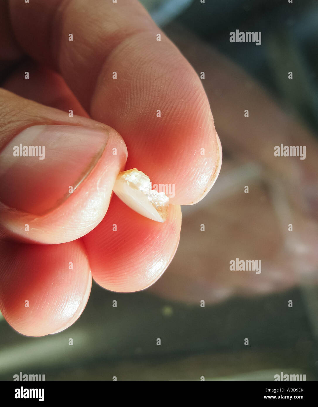 Fallen off old filling with a cutter. The seal of the tooth Stock Photo ...