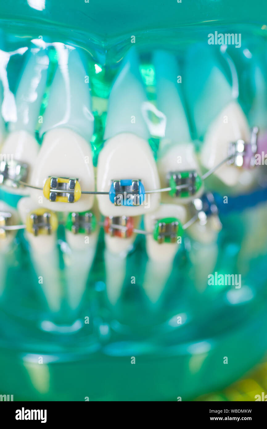 Modern metal retainers and plastic algners wire dental brackets teeth ...