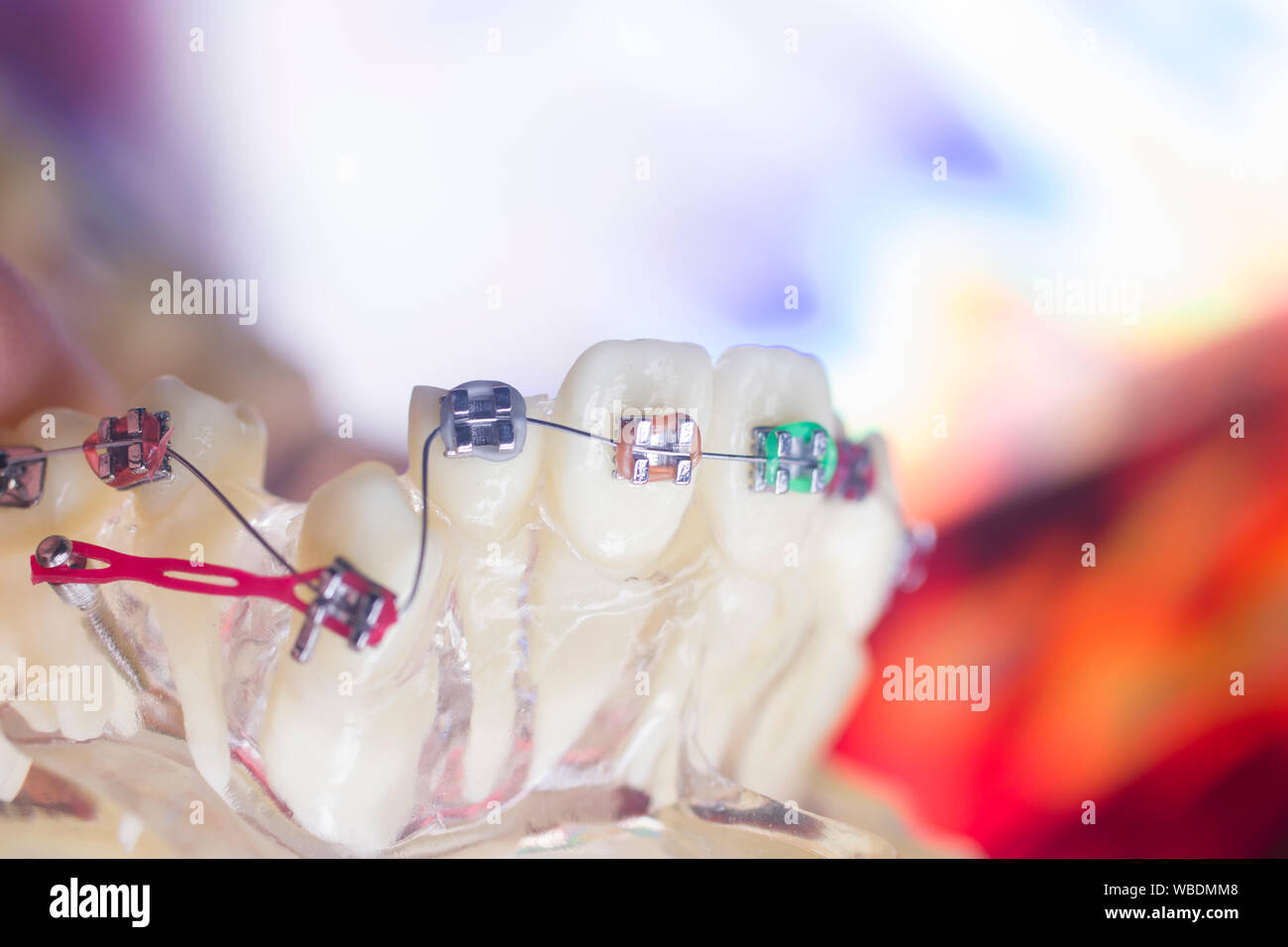 Modern metal retainers and plastic algners wire dental brackets teeth ...