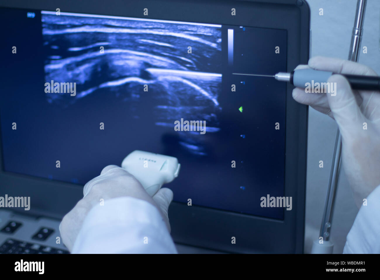 EPI Intratissue Percutaneous Electrolysis dry needling ultrasound ecography scan physiotherapy ...