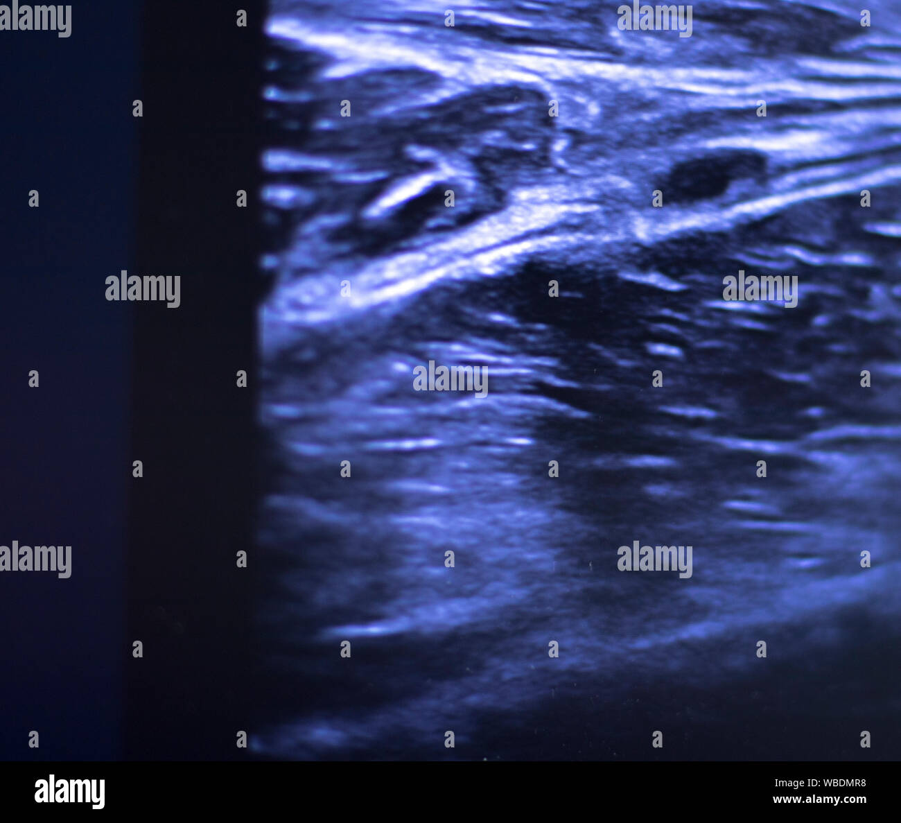 EPI Intratissue Percutaneous Electrolysis dry needling ultrasound ...