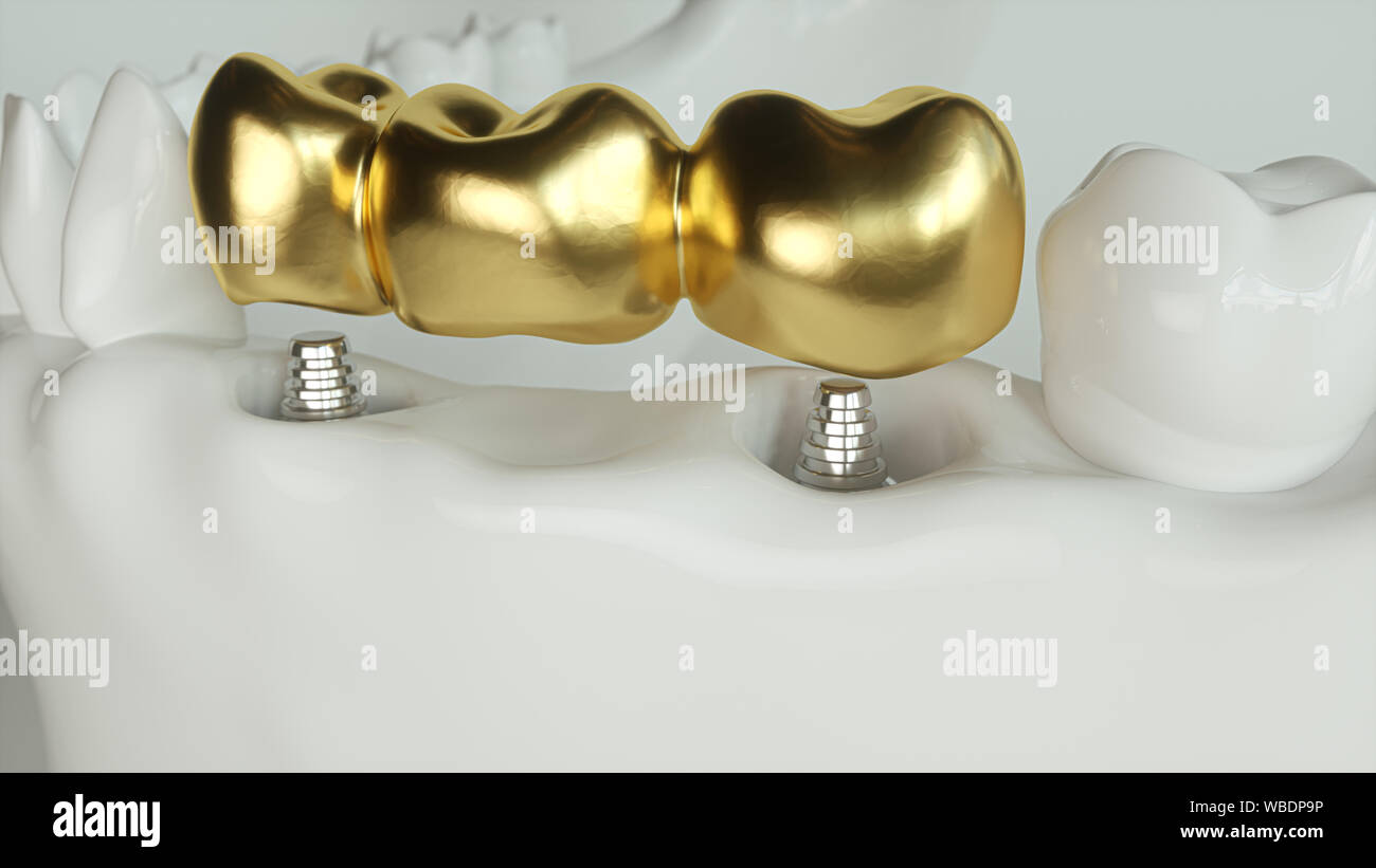 Implants with golden dental bridge - 3d rendering Stock Photo - Alamy