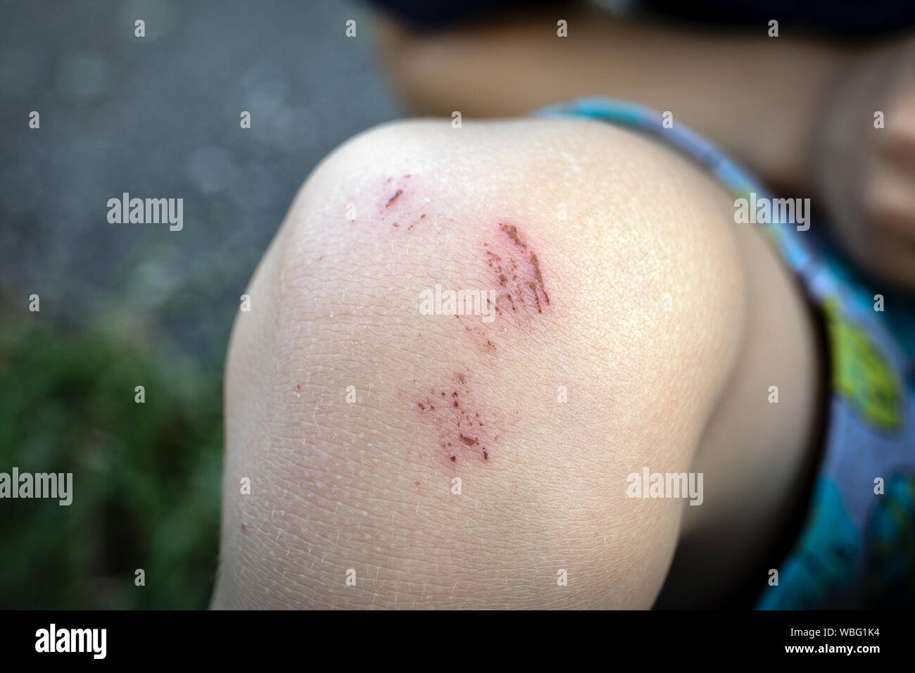 Scratched skin on the kid knee, injury after falling Stock Photo - Alamy