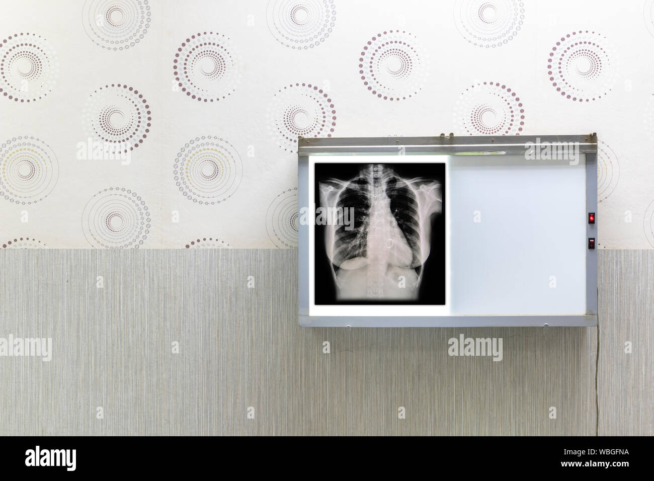 Chest X-rays with negatoscope on wall. Healthcare and Medical concept ...