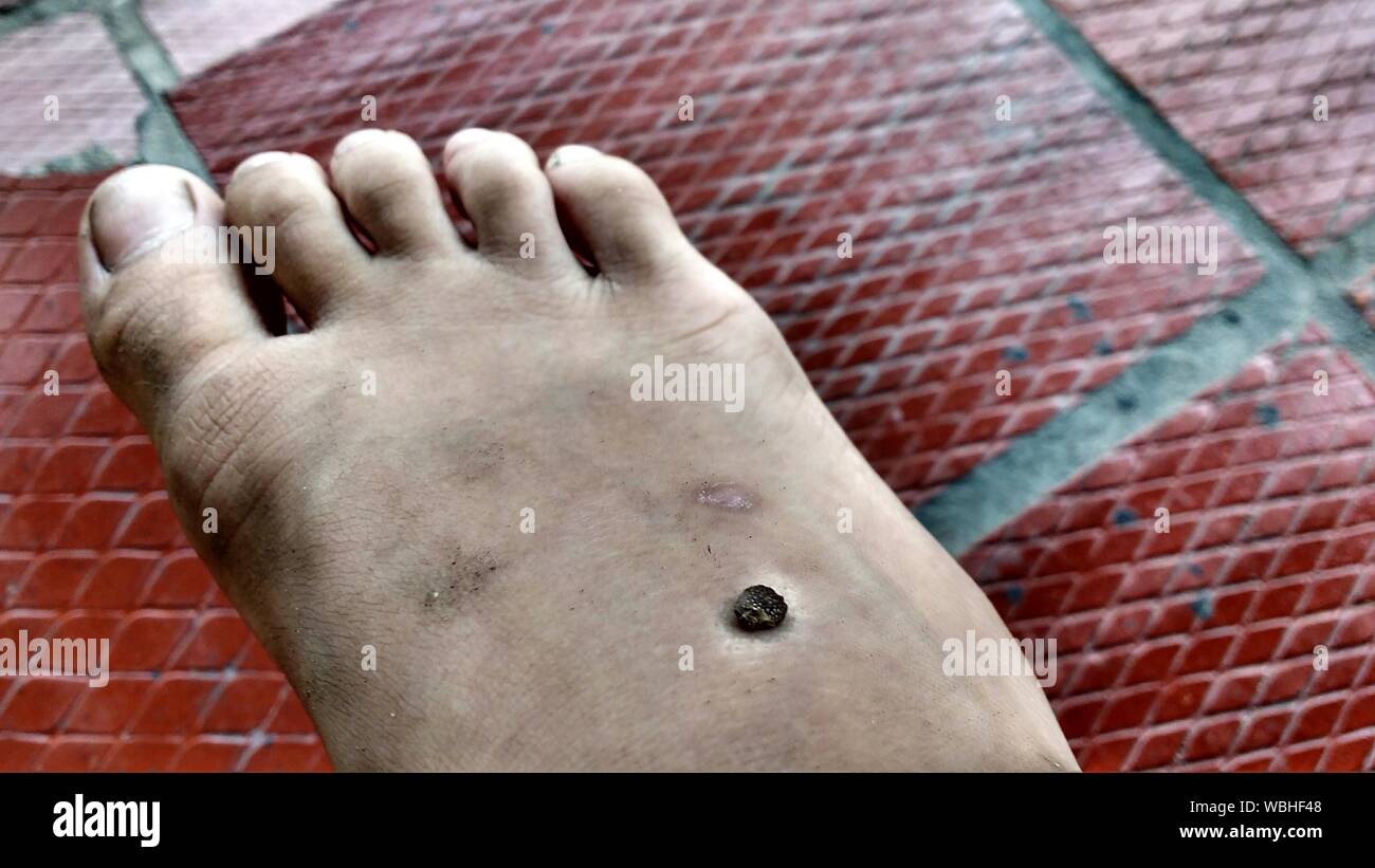 Close up and scar hi-res stock photography and images - Alamy