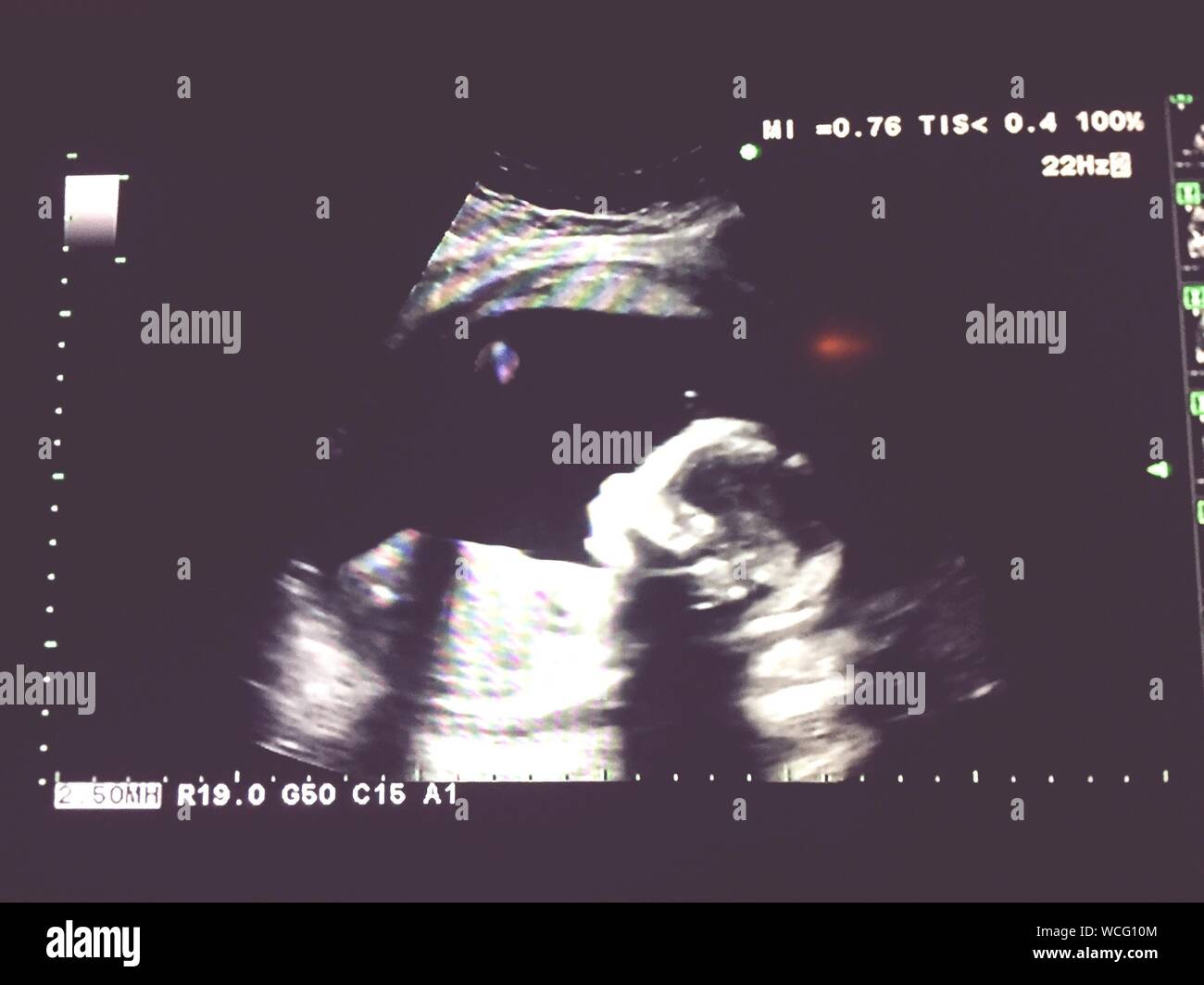 Real fetus hi-res stock photography and images - Alamy