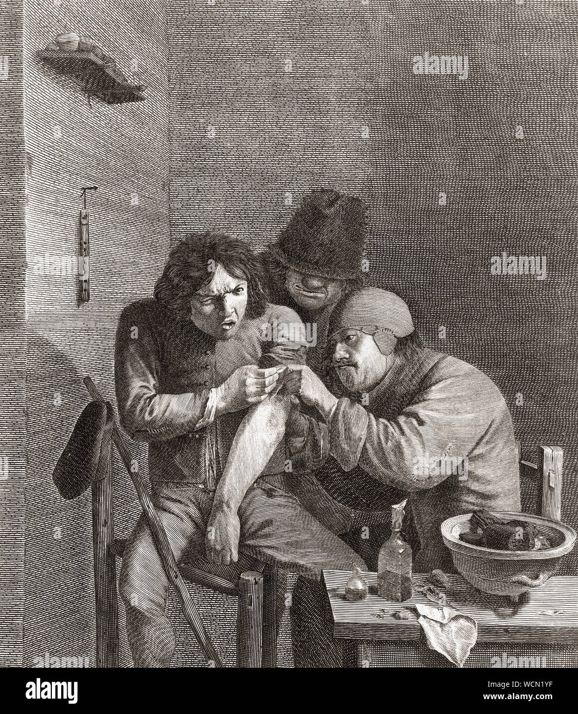 A surgeon operates on the arm of a patient in the 17th century. After a ...