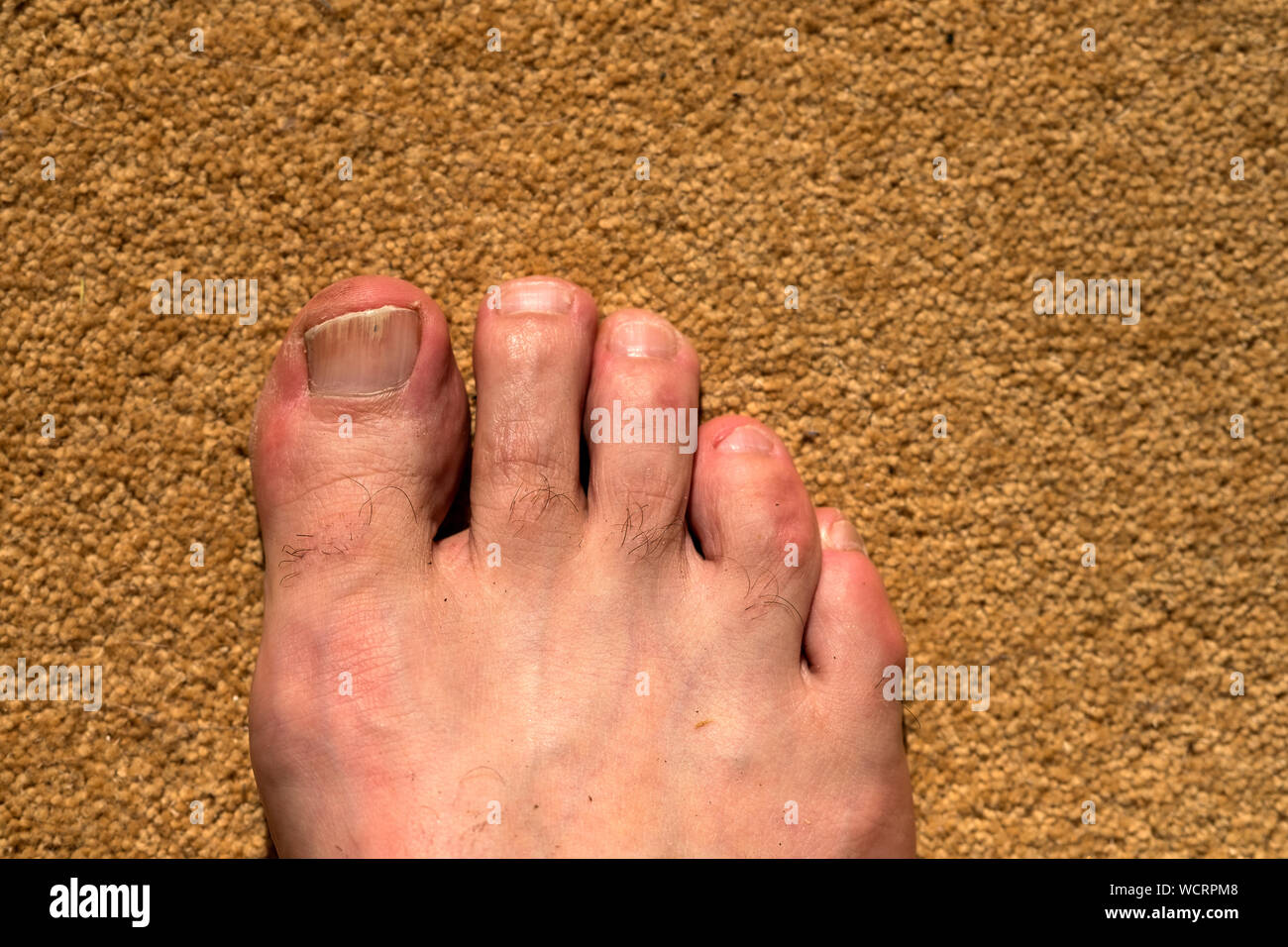 White mans bare feet bad toes Stock Photo - Alamy
