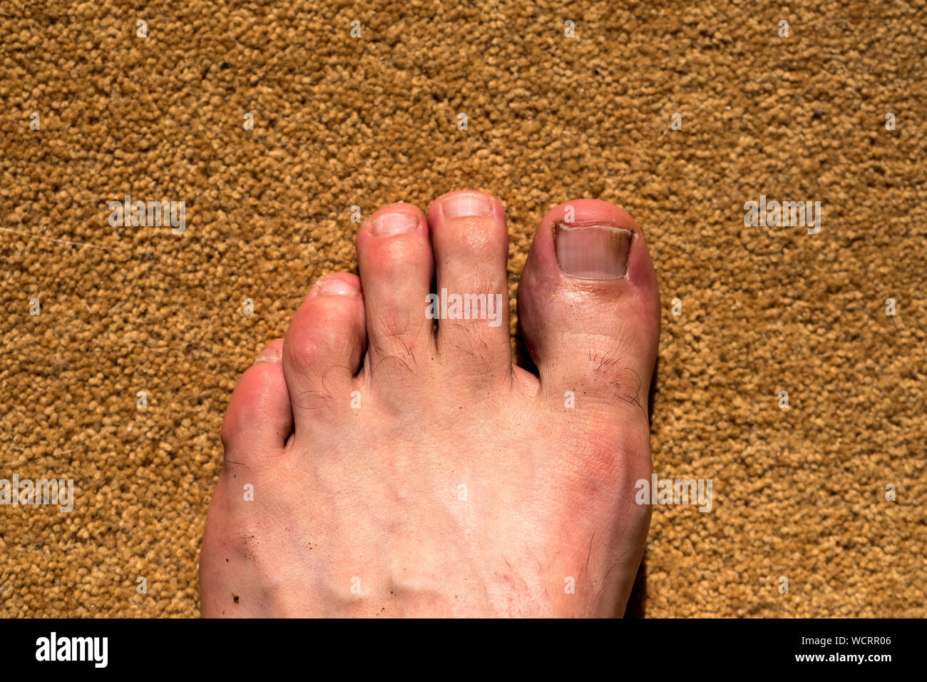 Toe Infection High Resolution Stock Photography and Images - Alamy