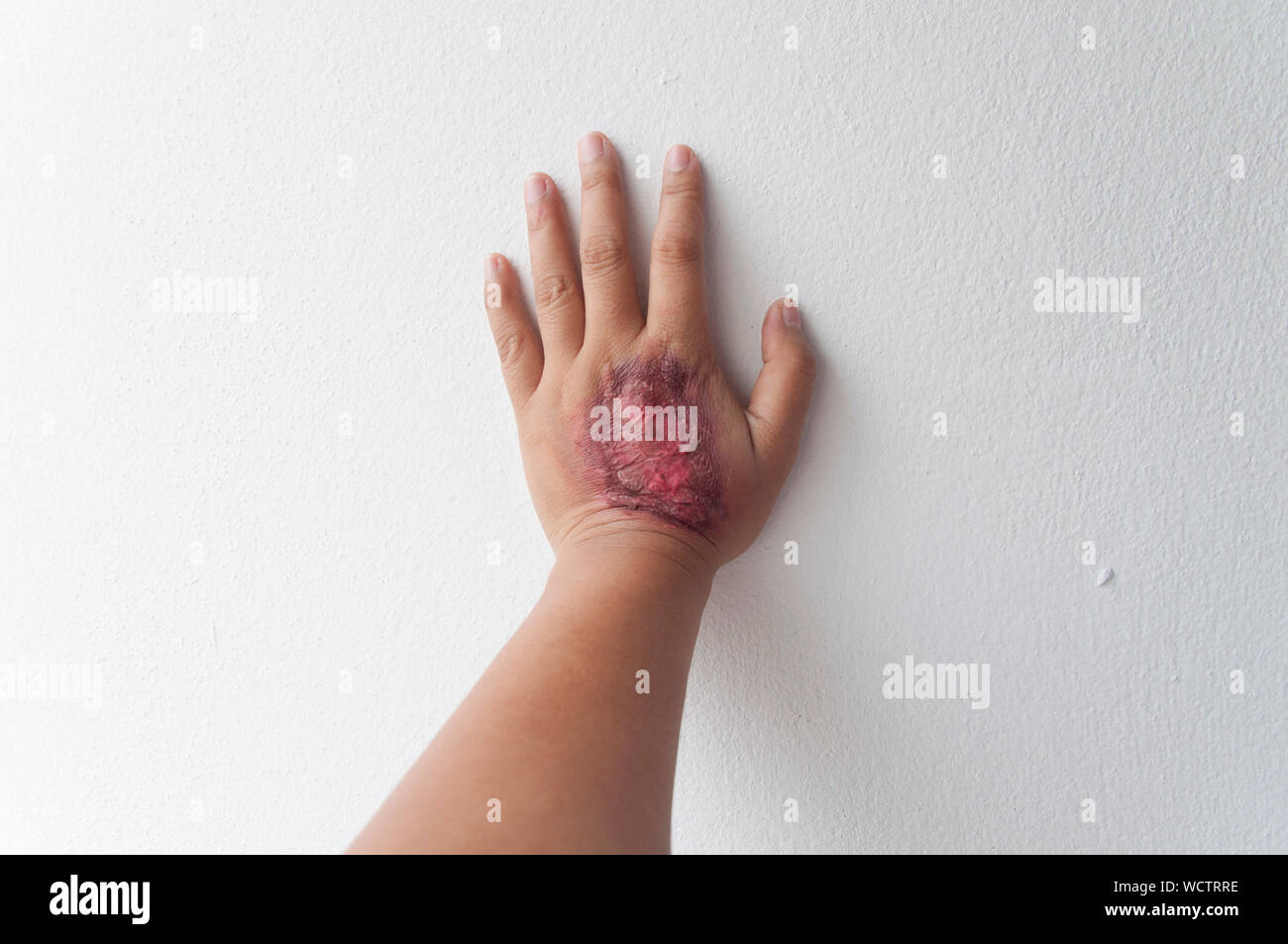 Burnt human body hi-res stock photography and images - Alamy