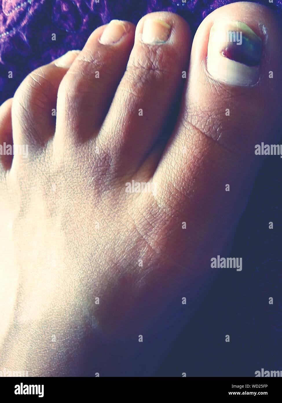 Bruise leg hi-res stock photography and images - Alamy