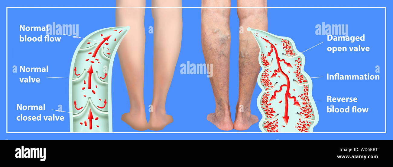 Varicose veins on a female senior legs. The structure of normal and ...