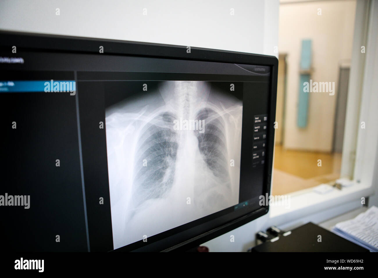 Details with a thoracic X-Ray on a computer monitor inside a clinic ...