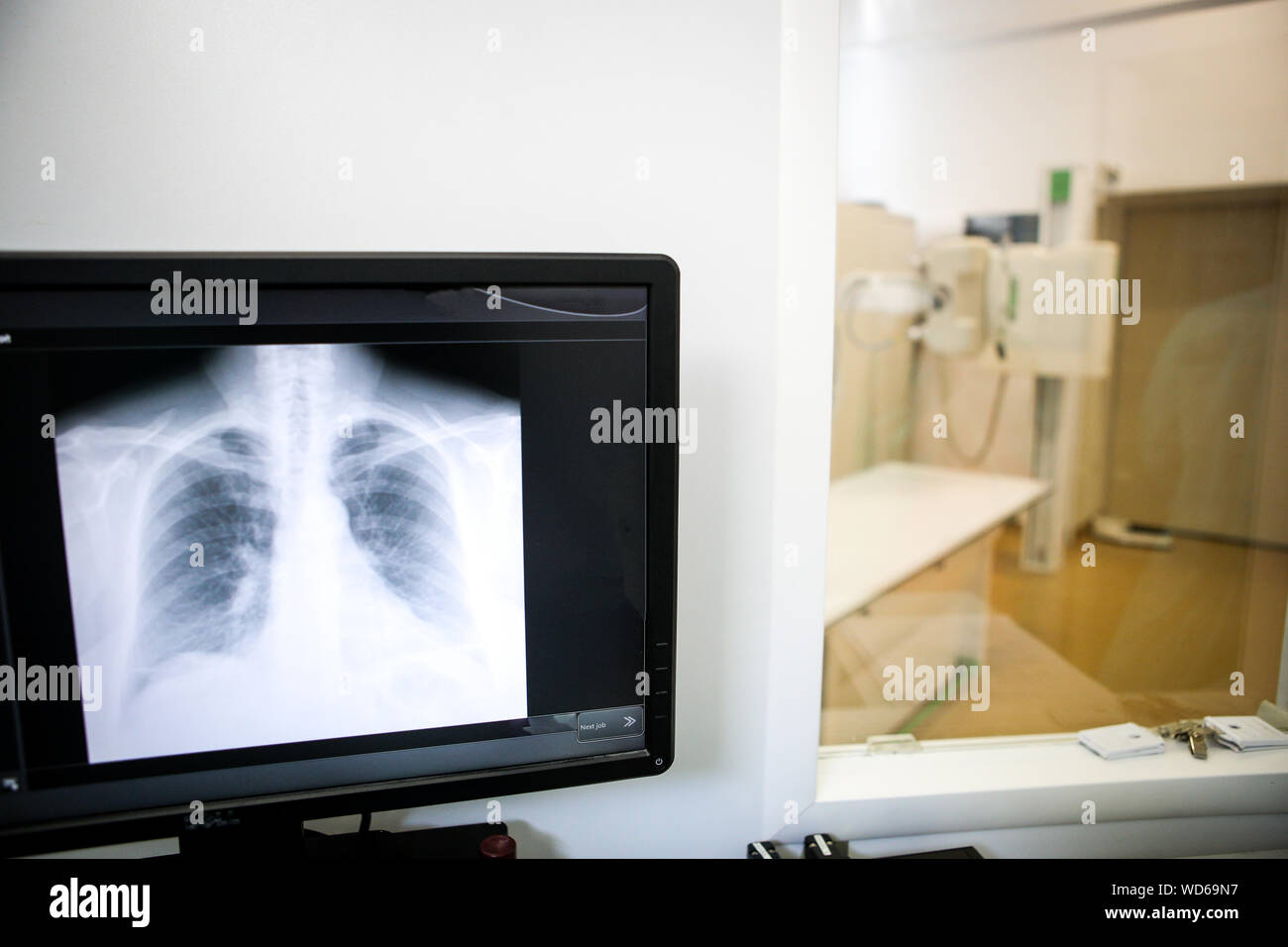 Details with a thoracic X-Ray on a computer monitor inside a clinic ...