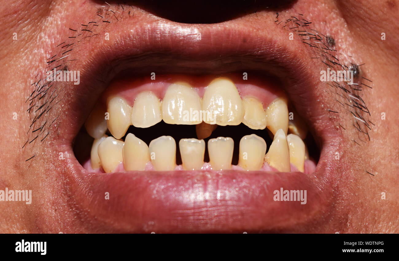 Dirty teeth hi-res stock photography and images - Alamy