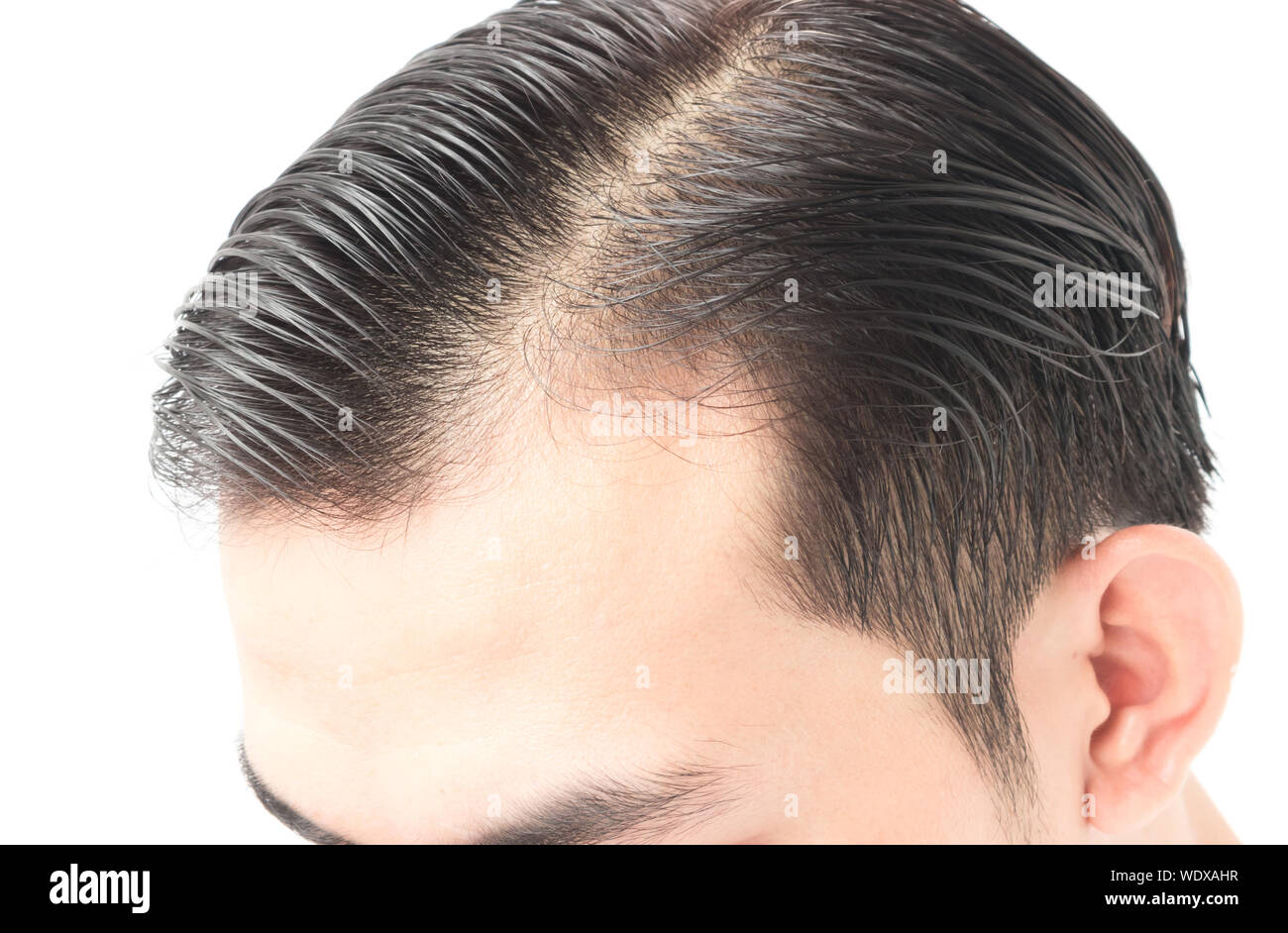 High Hairline High Resolution Stock Photography and Images - Alamy