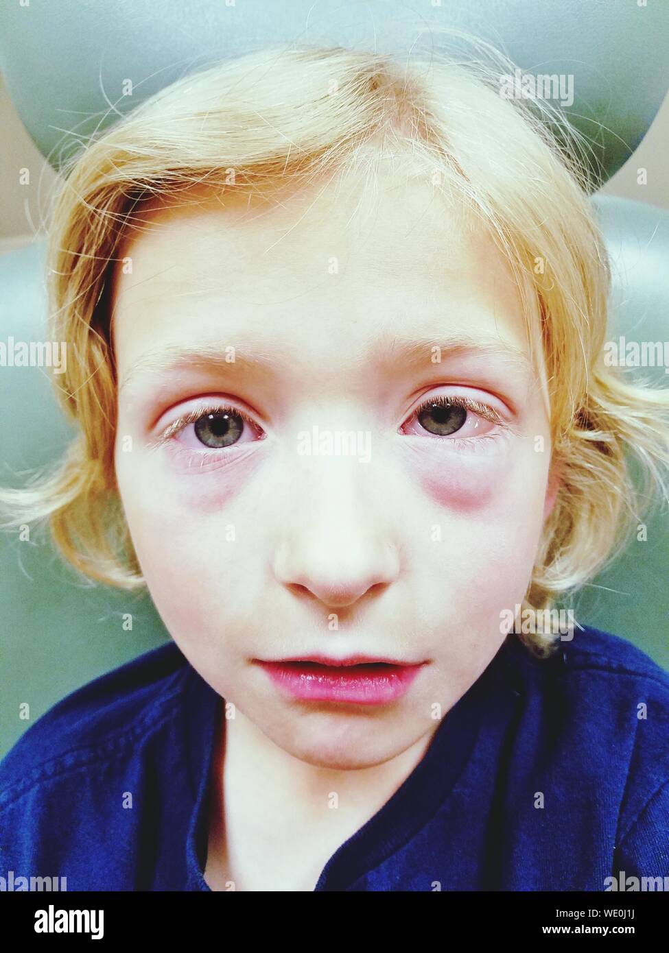 Conjunctivitis boy hi-res stock photography and images - Alamy