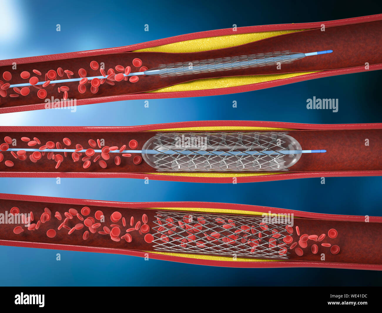 3d rendering balloon angioplasty procedure with stent in vein Stock ...