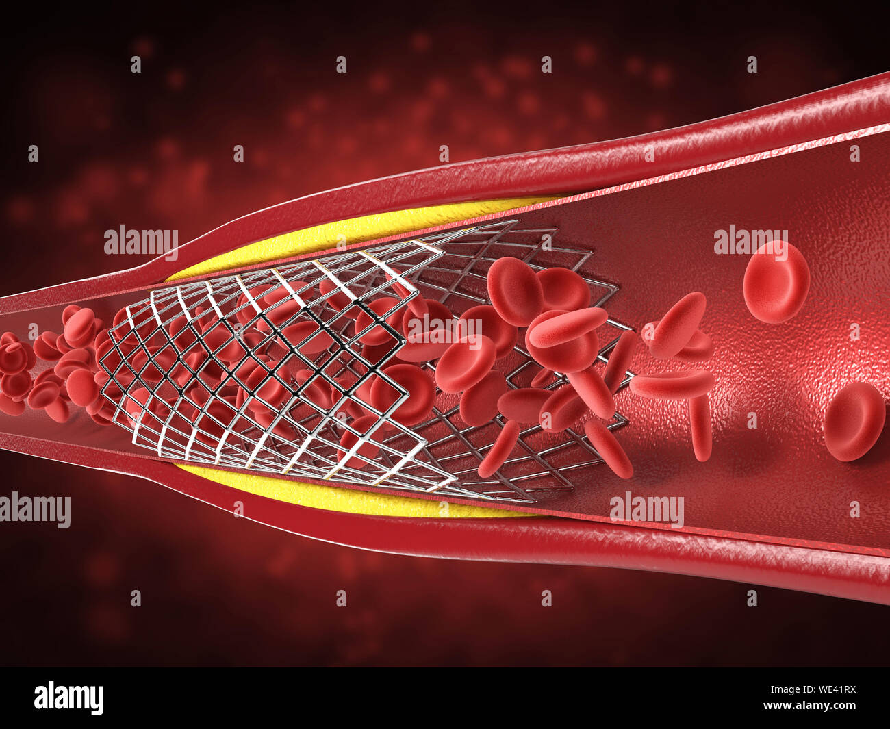 3d rendering balloon angioplasty procedure with stent in vein Stock ...