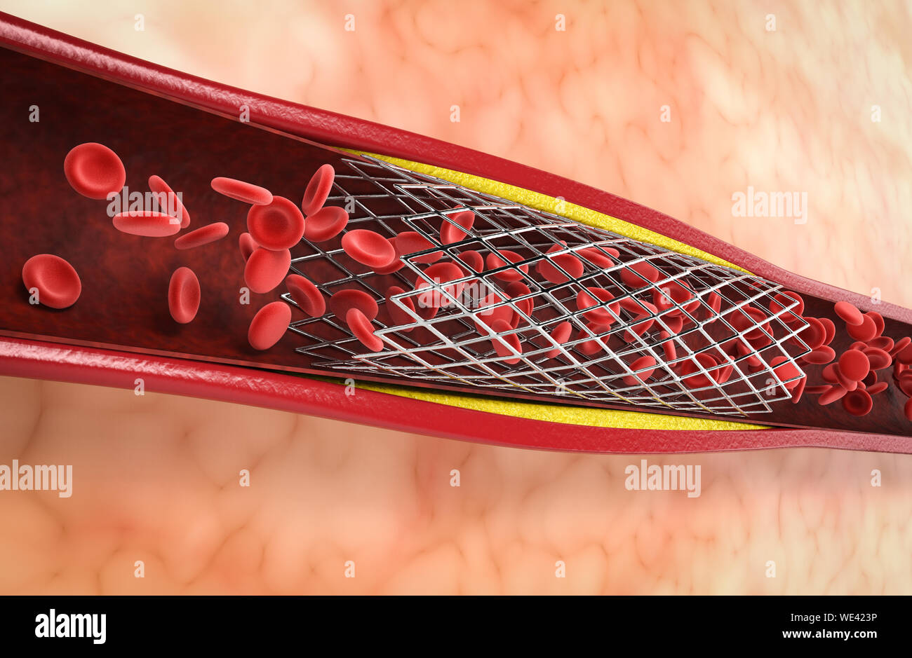 Coronary artery bypass procedure hi-res stock photography and images ...