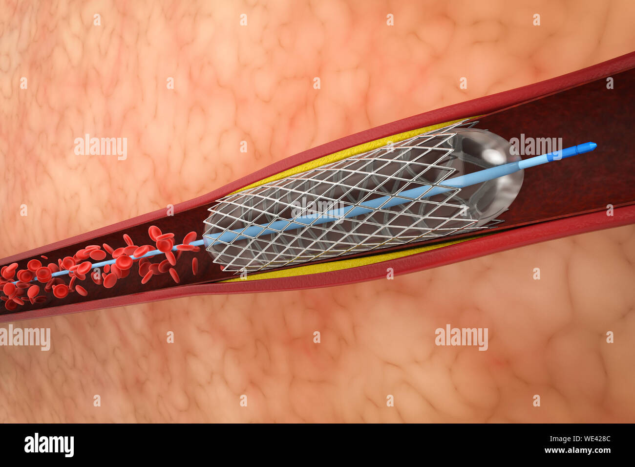 3d rendering balloon angioplasty procedure with stent in vein Stock ...