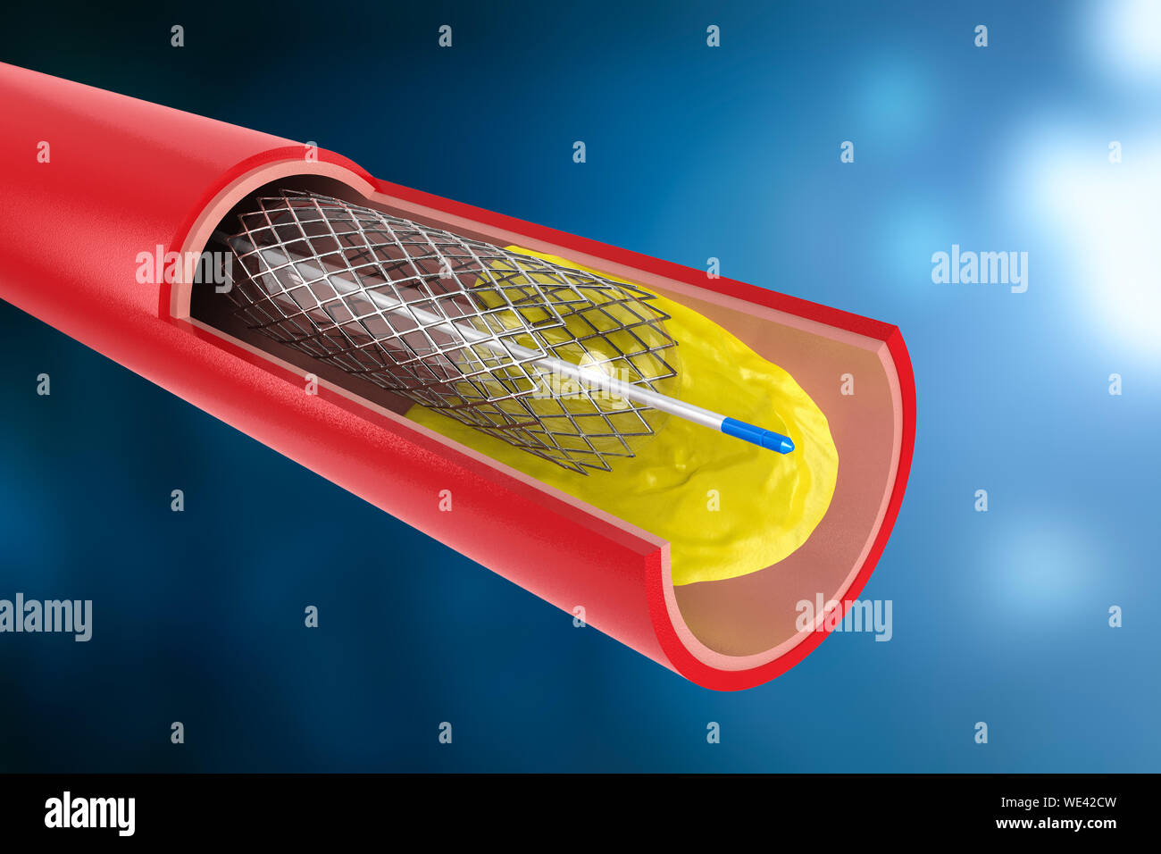 Balloon Catheter High Resolution Stock Photography and Images - Alamy