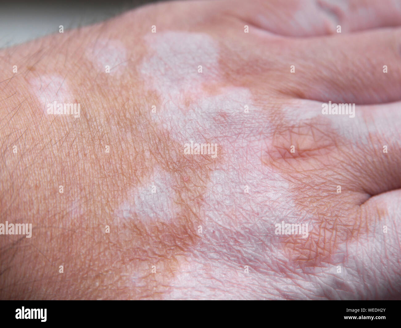 Vitiligo hi-res stock photography and images - Alamy