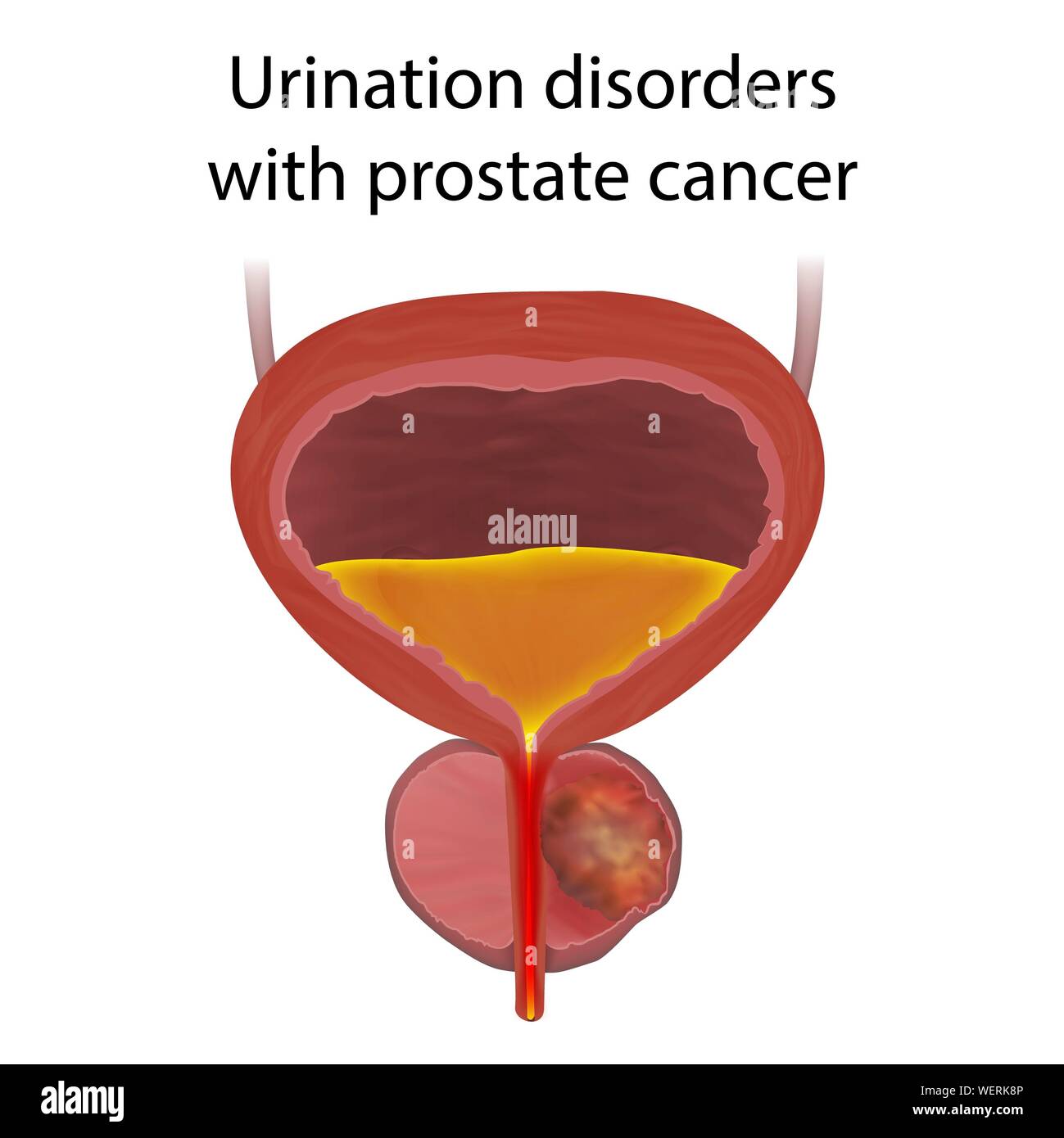 Urinary disorders with prostate cancer, illustration Stock Photo - Alamy