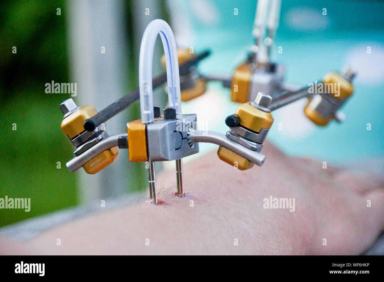 External fixation hi-res stock photography and images - Alamy