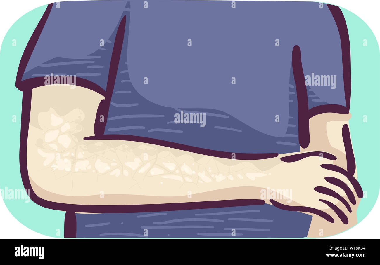 Flaky skin cartoon hi-res stock photography and images - Alamy