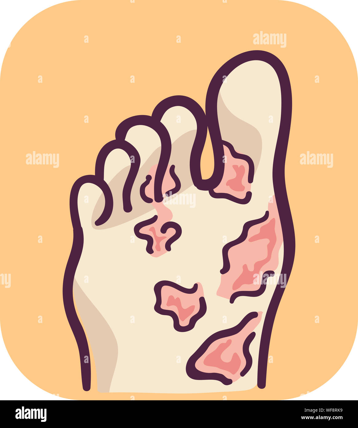 Illustration of Foot Blisters Stock Photo - Alamy