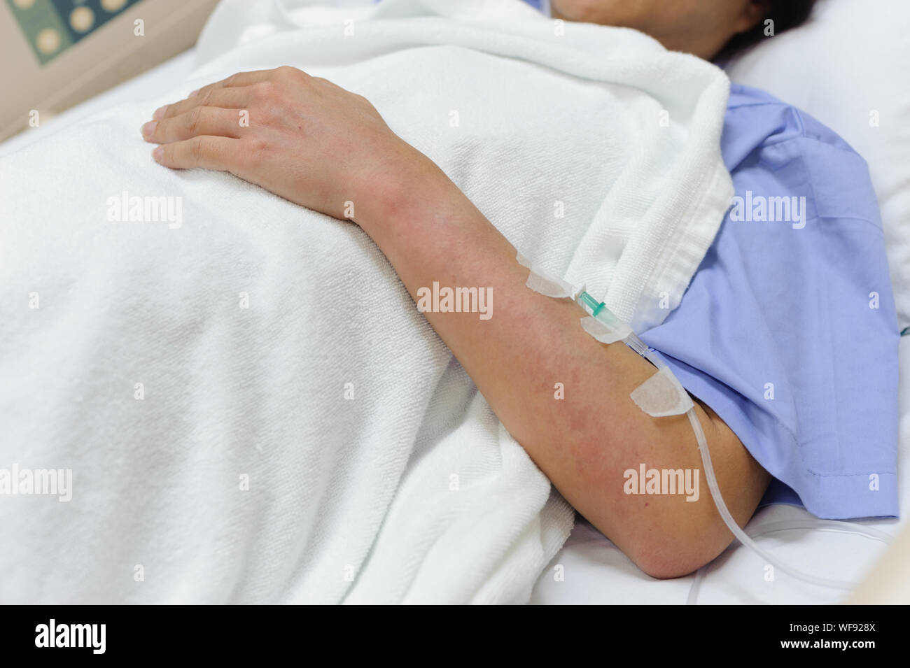Female patient with dengue fever red rashes stay on a hospital bed ...