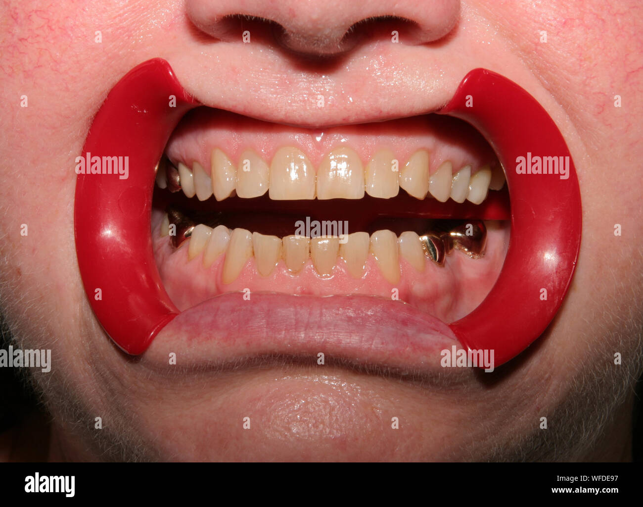 Retractor High Resolution Stock Photography and Images - Alamy