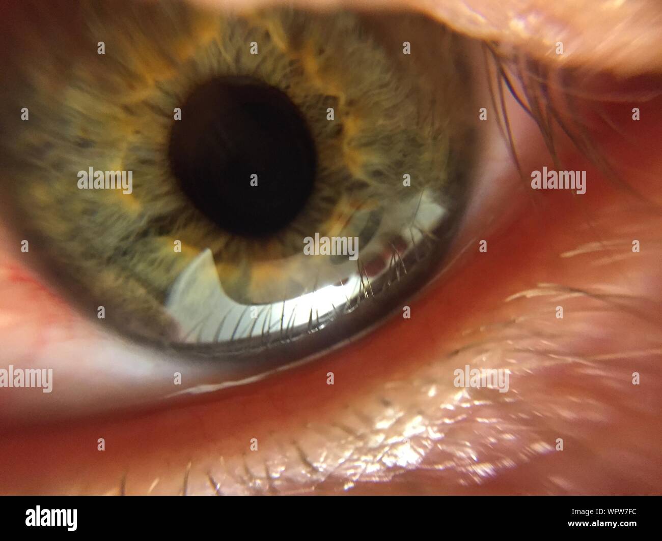 Dilation Eye High Resolution Stock Photography and Images - Alamy