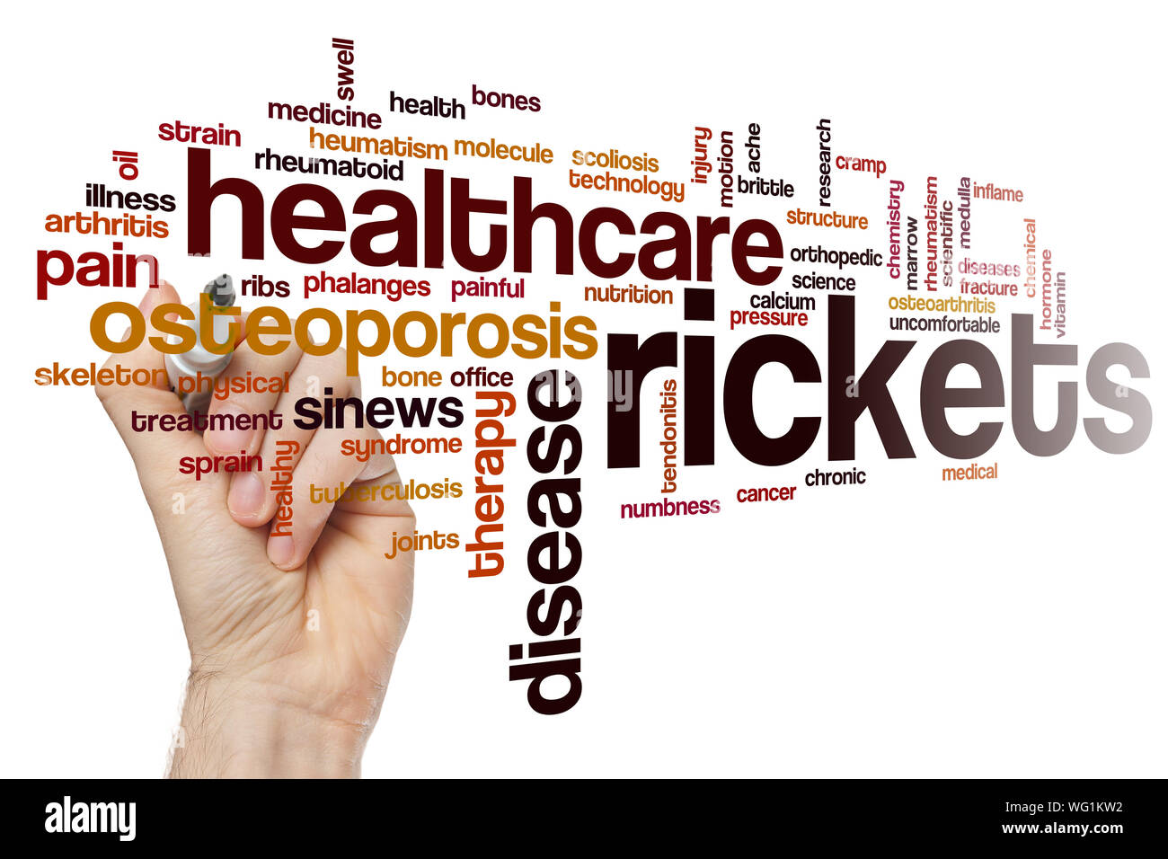 Rickets disease hi-res stock photography and images - Alamy