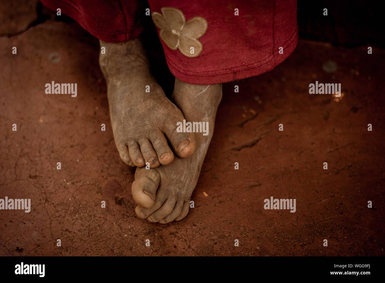 Bad feet hi-res stock photography and images - Alamy