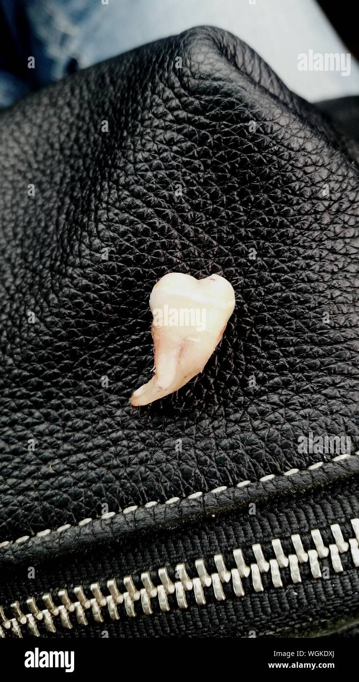 Wisdom tooth wisdom teeth hi-res stock photography and images - Alamy