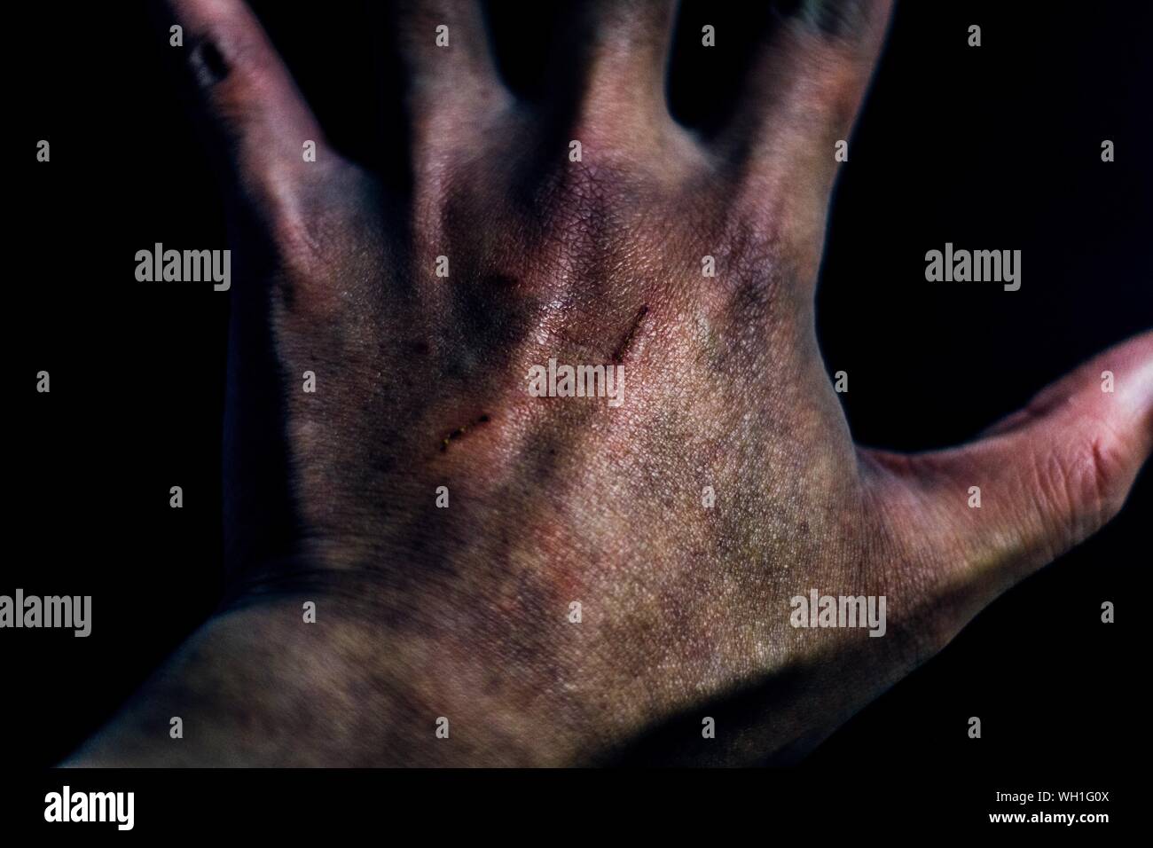 Swollen skin hi-res stock photography and images - Alamy