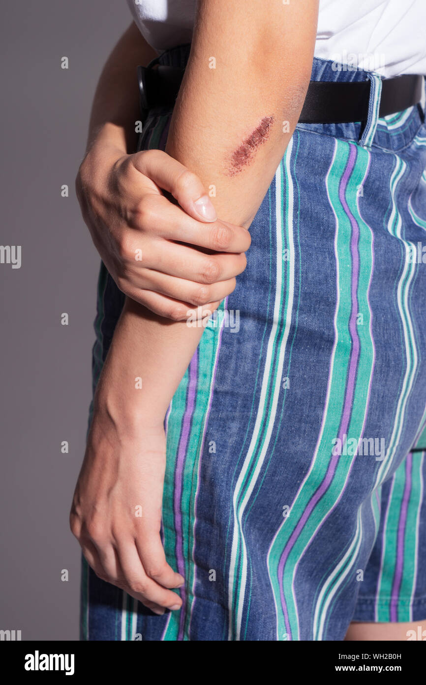 Elbow wound hi-res stock photography and images - Alamy