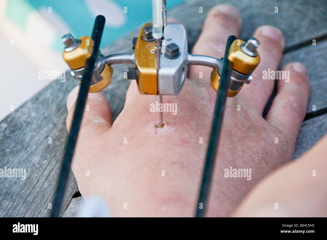 External fixation hi-res stock photography and images - Alamy