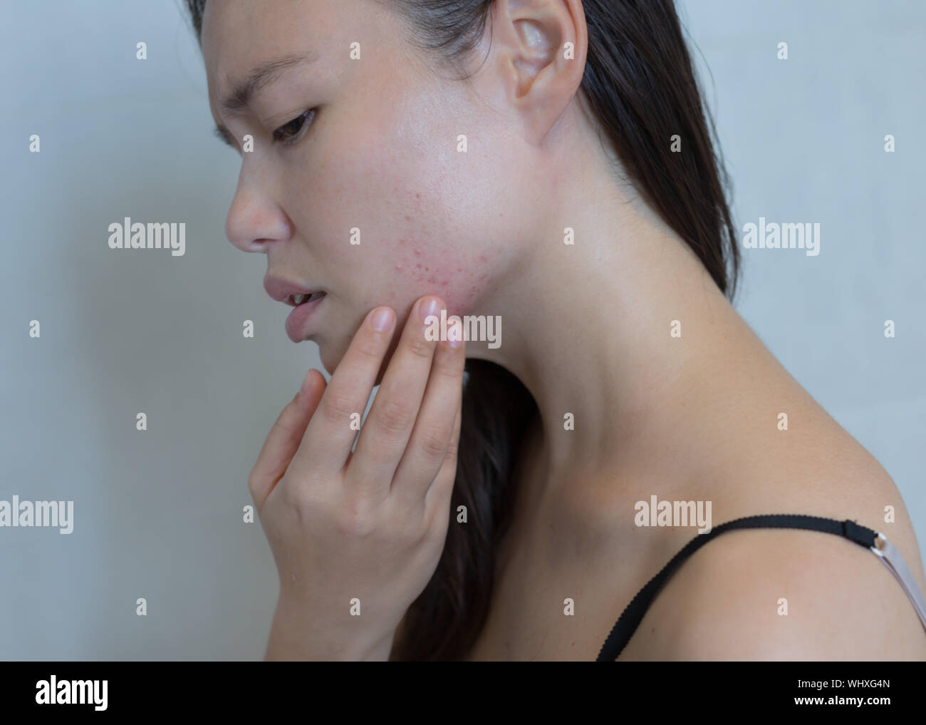 Stressed woman breaking out with acne on her face Stock Photo - Alamy
