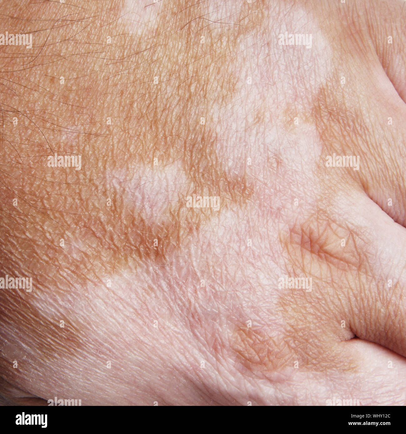 Skin affected by vitiligo hi-res stock photography and images - Alamy