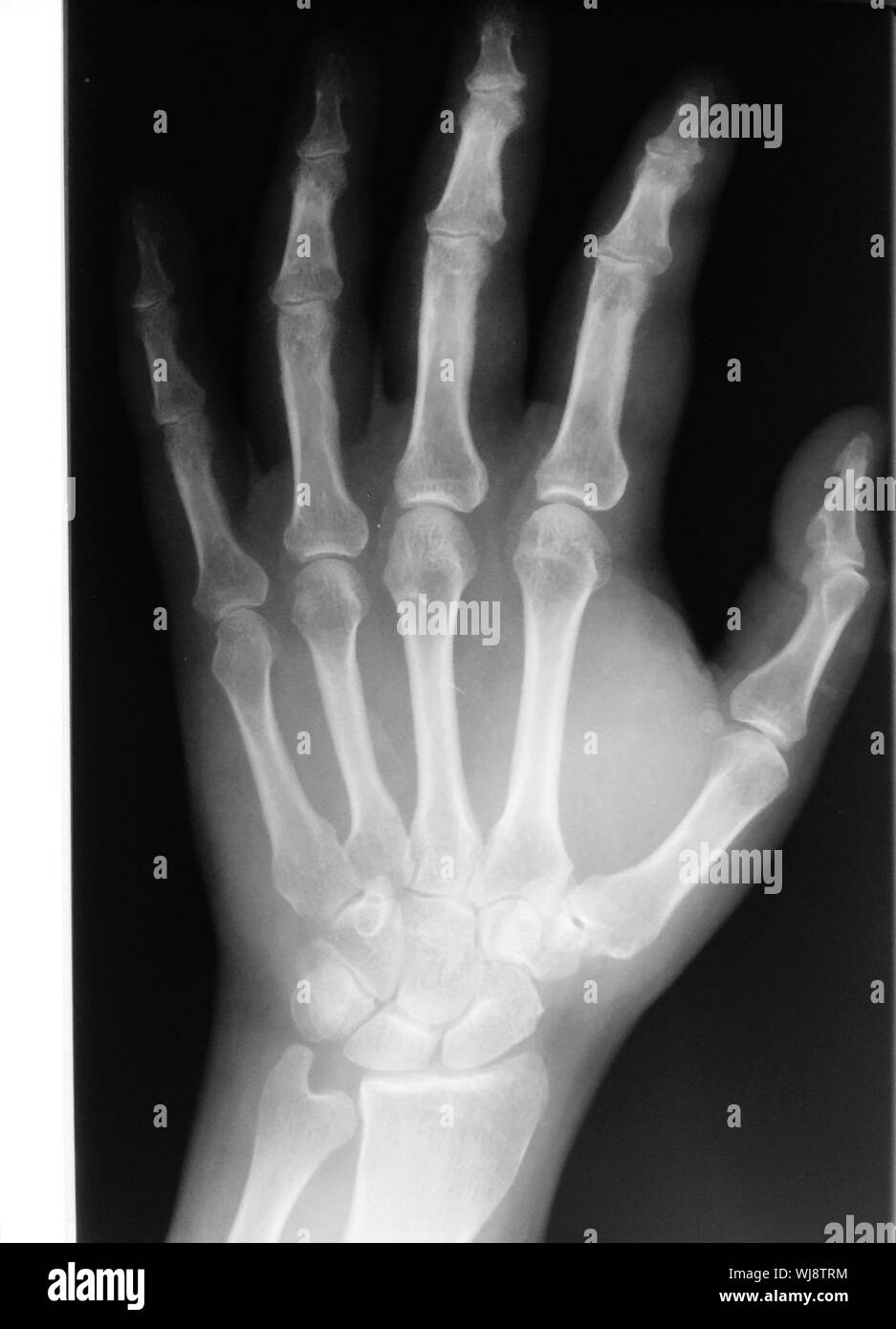 X Ray Hand Stock Photos & X Ray Hand Stock Images - Alamy