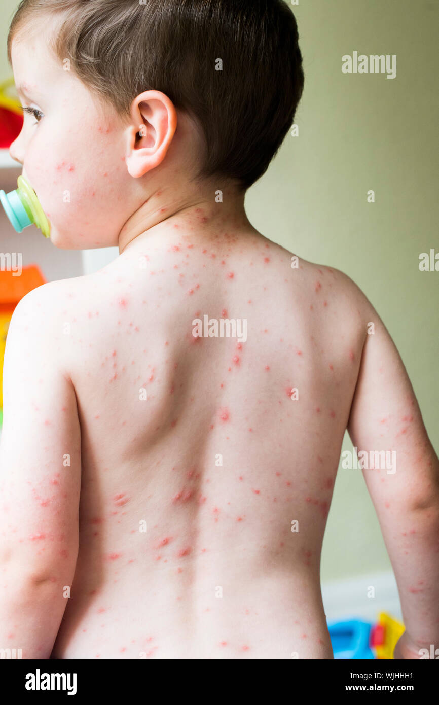 A two year old boy suffers from Chickenpox. also known as varicella ...
